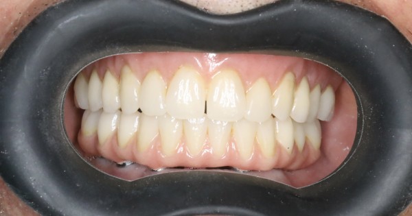 VisionButler MedS with fixed lower arch and upper denture-600x315w.JPG