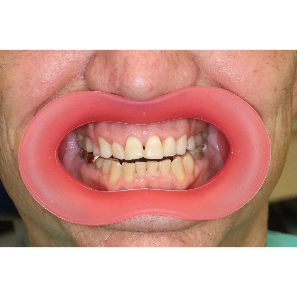 Find out more about suitability in dentistry. VisionButler-Autoclavable ...