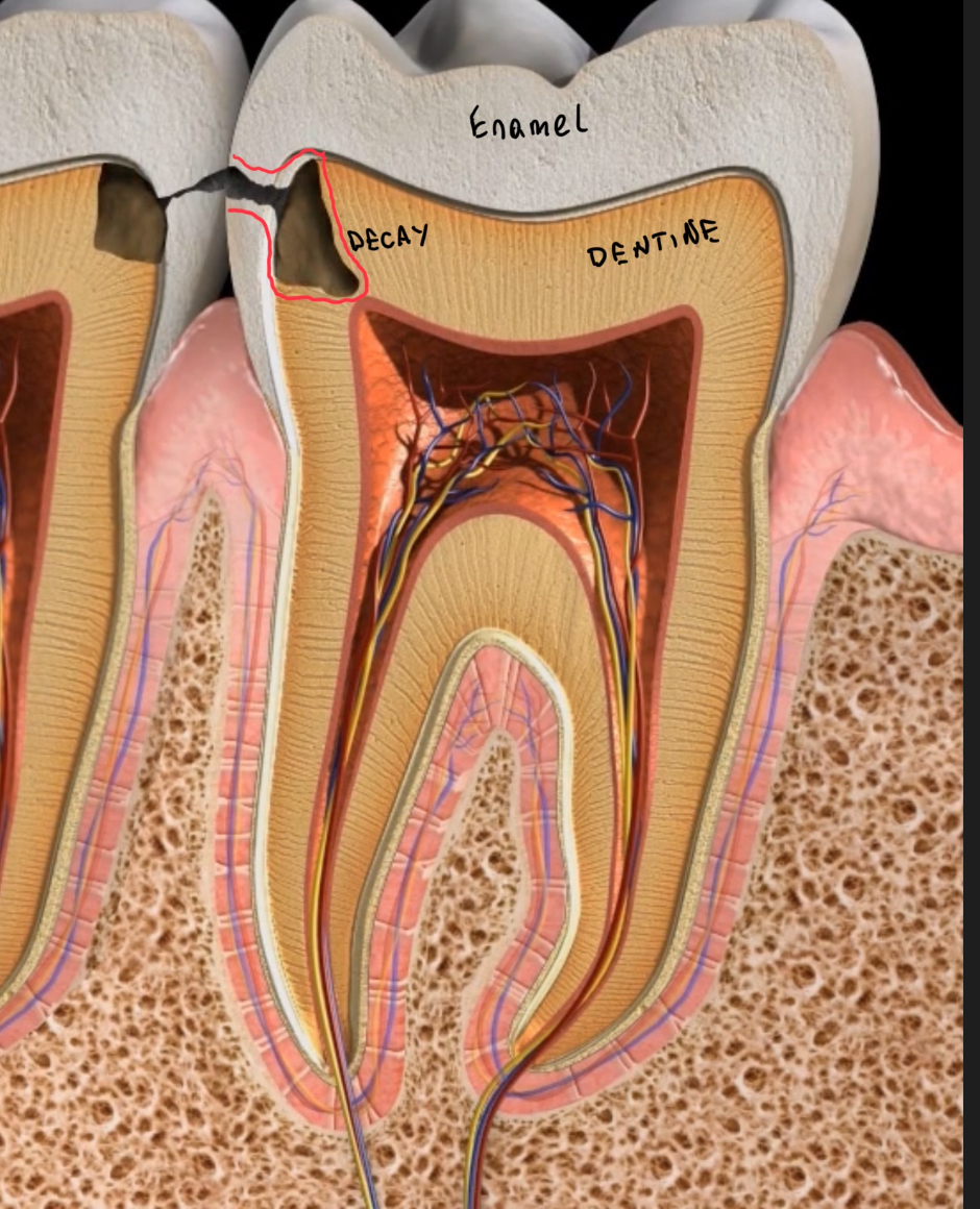 A tooth has a layer of glass like enamel over the body of the tooth ...