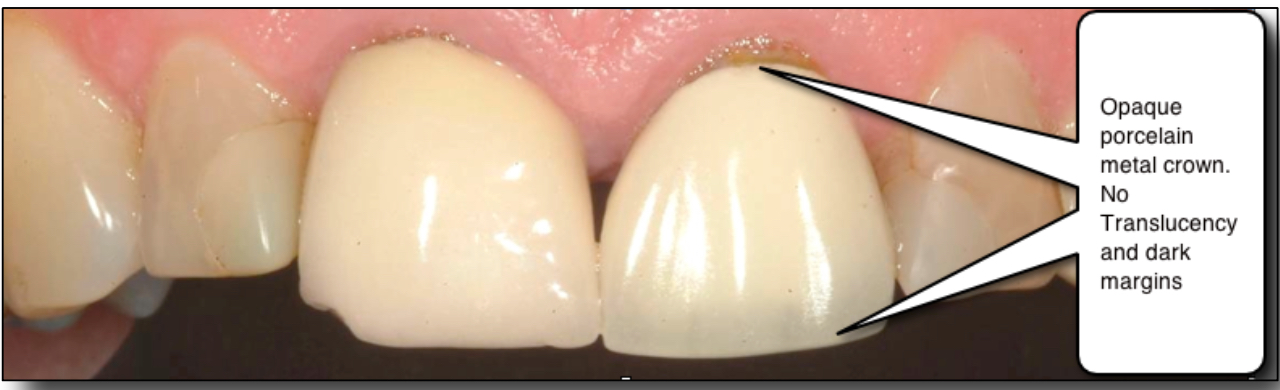 Black lines around the crowns